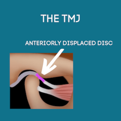 Does your Jaw Click? Here's why... - The TMJ Clinic | Massage Therapy ...